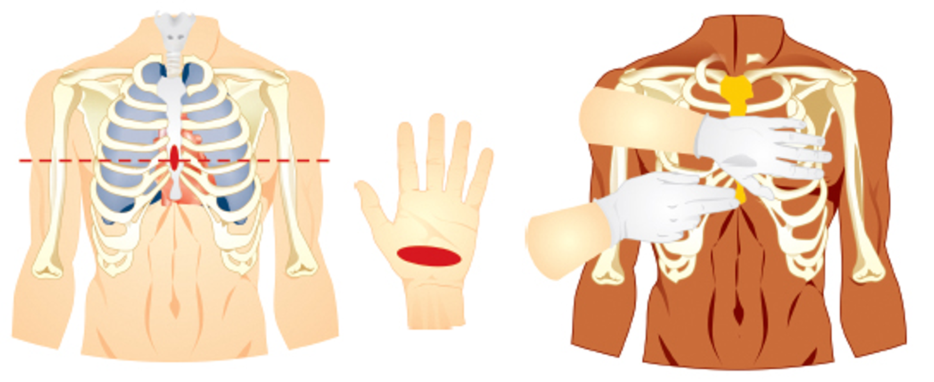 Parada cardíaca: o que fazer e como realizar os primeiros socorros – S2 ...